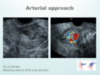 Glubran2 for endovascular use: indications and techniques - GEM Italy