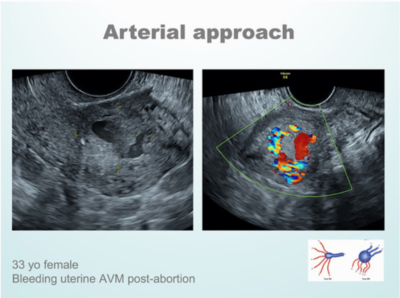 Glubran2 for endovascular use: indications and techniques – GEM Italy