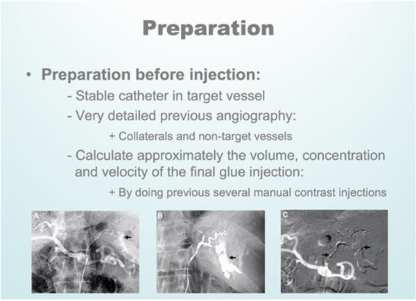 Glubran2 for endovascular use: indications and techniques – GEM Italy