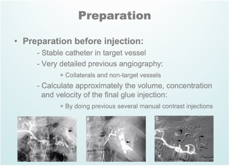 Glubran2 for endovascular use: indications and techniques – GEM Italy