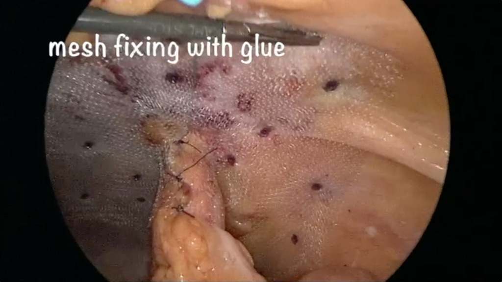 Riparazione laparoscopica dell'Ernia Parastomale - GEM Italy